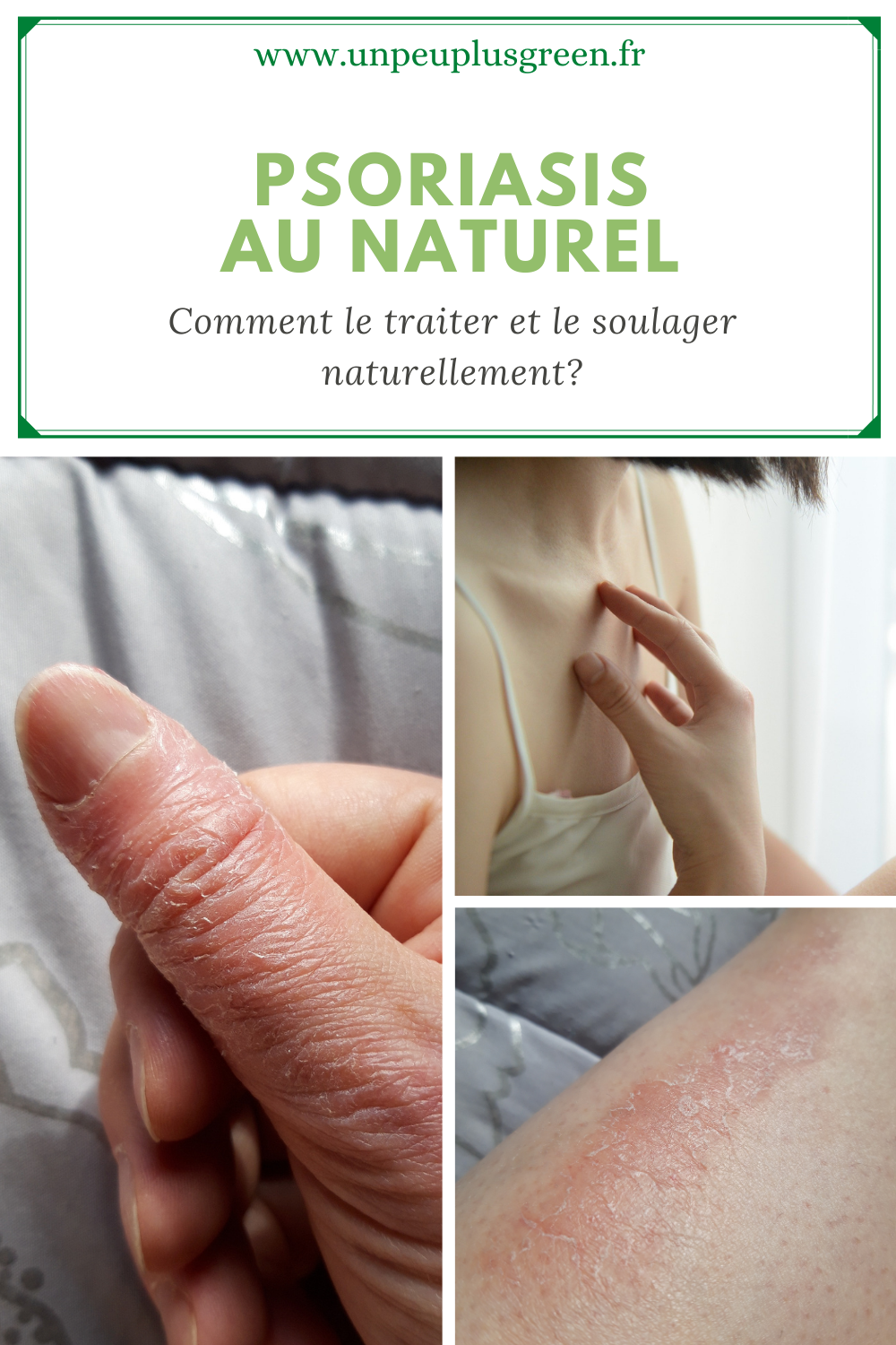 Psoriasis: Comment le soigner naturellement? - Un Peu Plus Green